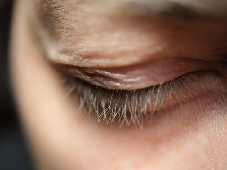 Basal Cell Carcinoma on Eyelid: Symptoms, Treatment, Outlook