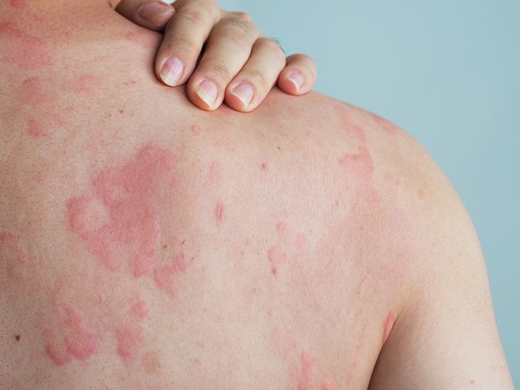 Autoimmune Hives: Causes, Symptoms, Treatments, and More