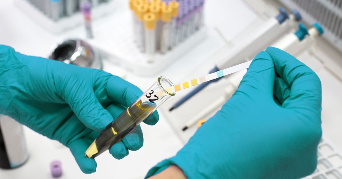 Diabetes Insipidus: Which Lab Tests Are Used to Diagnose It?