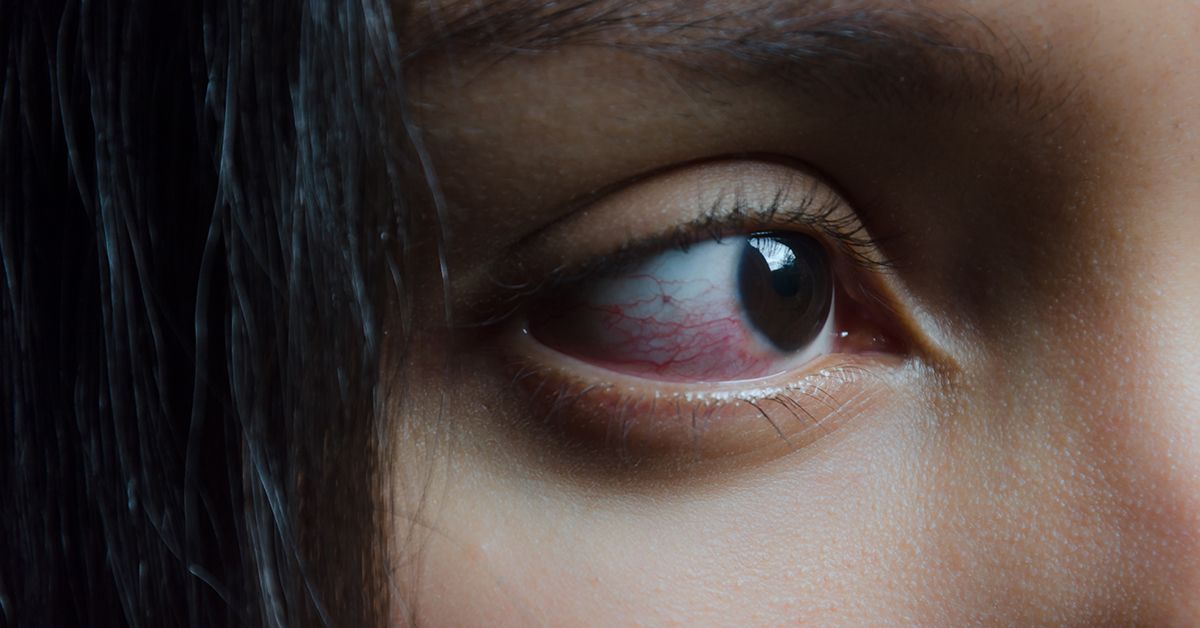 What to Know About Ulcerative Colitis and Your Eyes