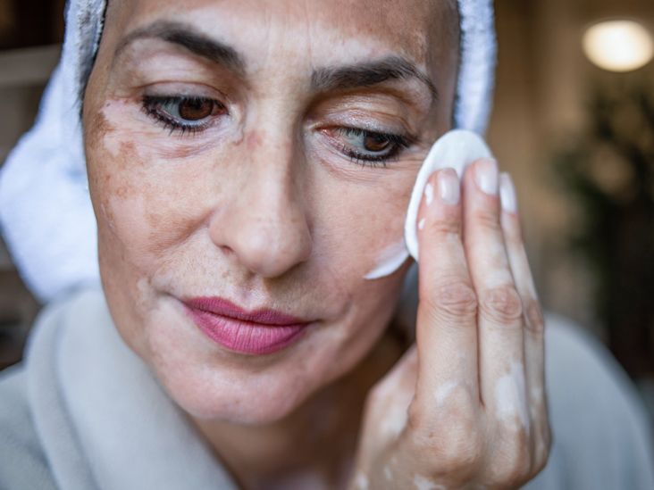 Addison’s Disease Effects on Skin: Symptoms and Treatment