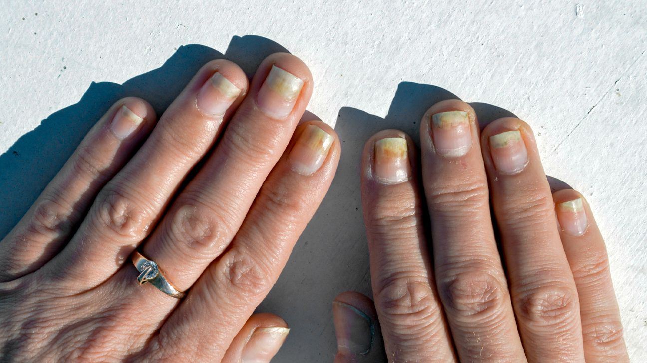 Nail Abnormalities: Symptoms, Causes, and Prevention