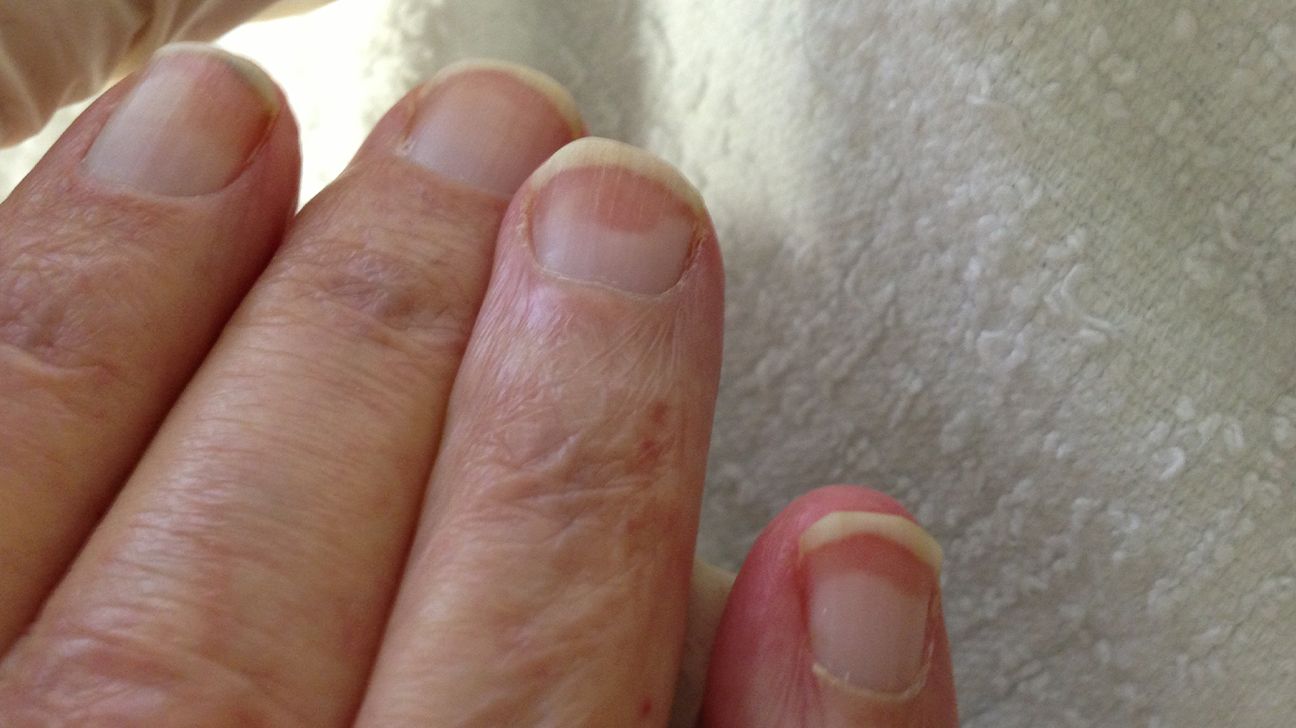Nail Abnormalities: Symptoms, Causes, and Prevention