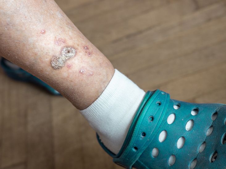 Venous Ulcers: Vs. Arterial Ulcers, Pictures, Treatment, and More