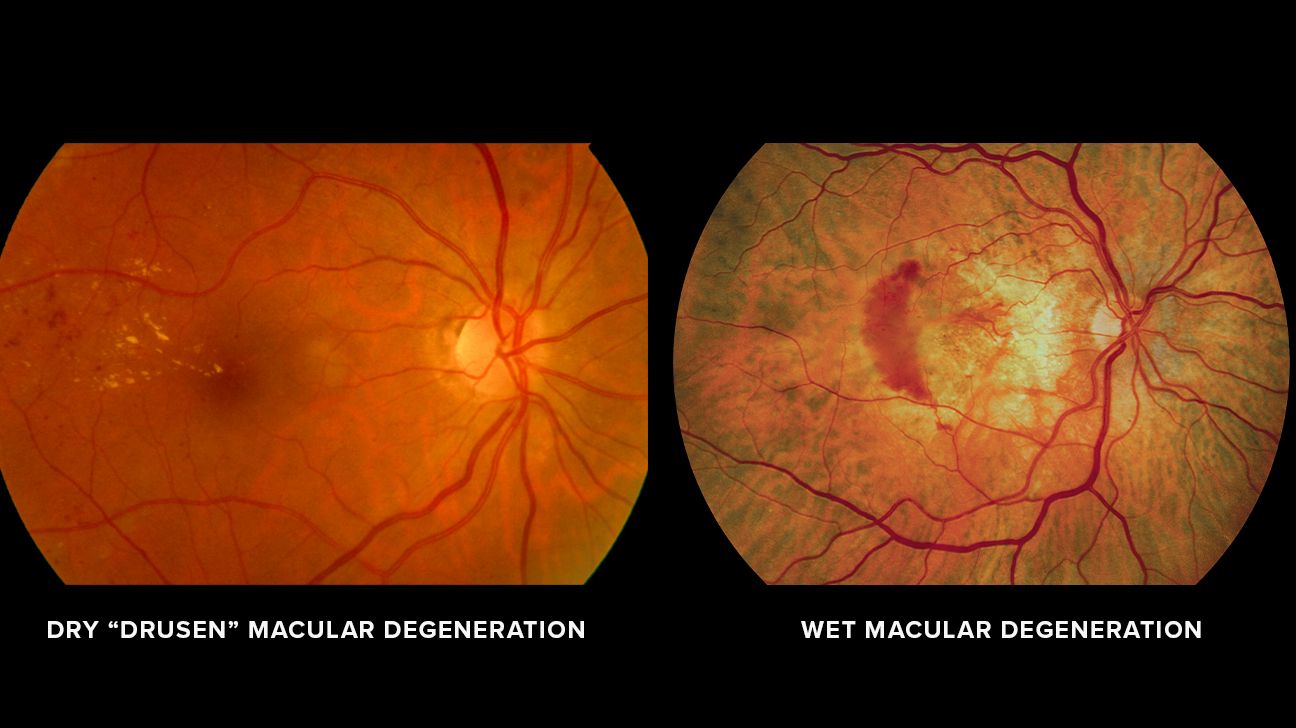 Macular Atrophy Skin