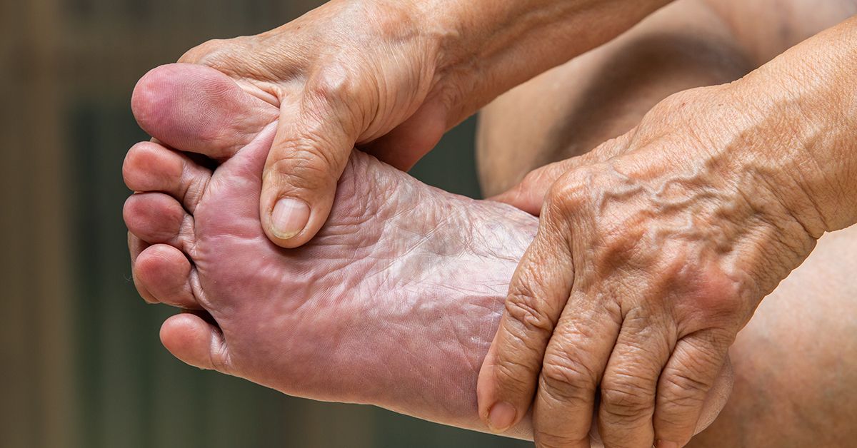 Plantar Vein Thrombosis: Symptoms, Diagnosis, and Treatment