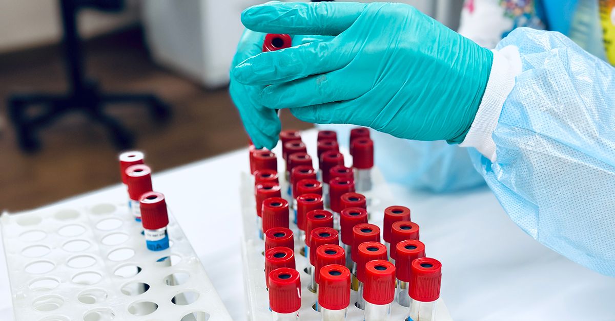 Fatty Liver Disease: Blood Tests for Diagnosis