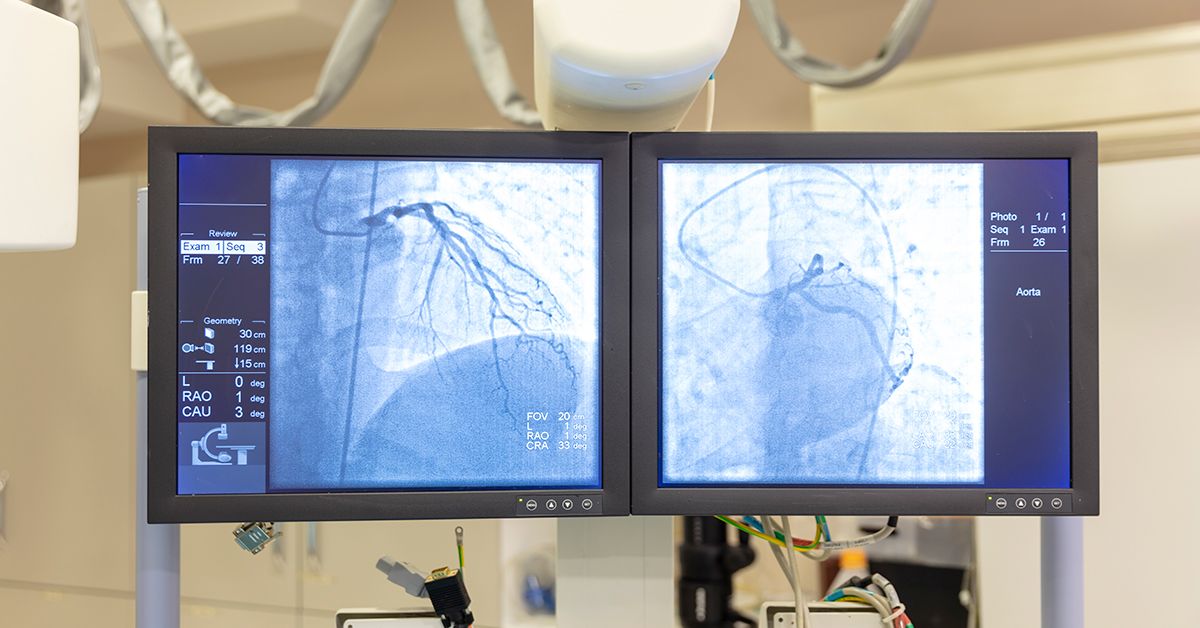 Carotid Angioplasty: What It’s Used for and What to Expect