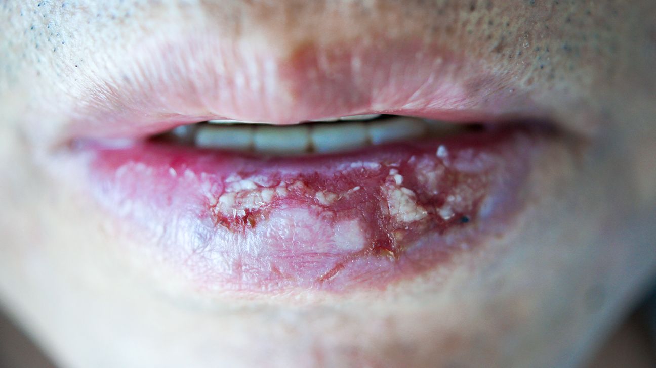 Skin Cancer Lower Lip Photoshoots - Infoupdate.org