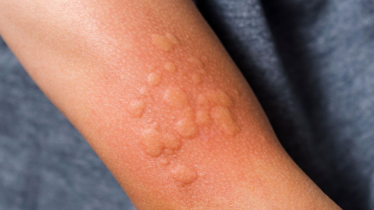 Small bumps on arms store
