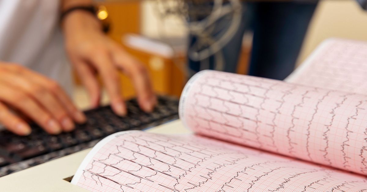 Wide Complex Tachycardia: Symptoms, Causes, and Treatment