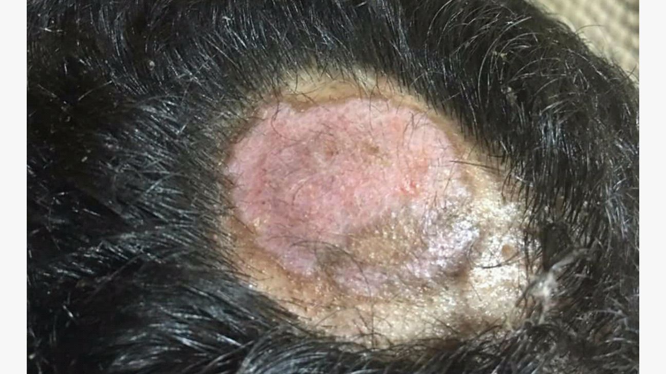 Lupus Pictures: What Does Lupus Look Like?