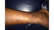 What Does A Lupus Rash Look Like On Your Legs In Cats Infoupdate