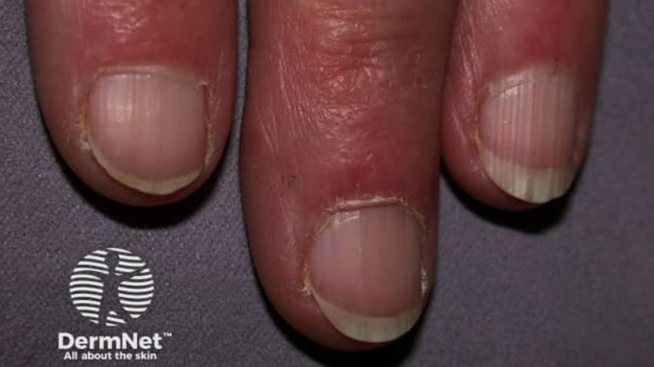 Lupus Pictures: What Does Lupus Look Like?