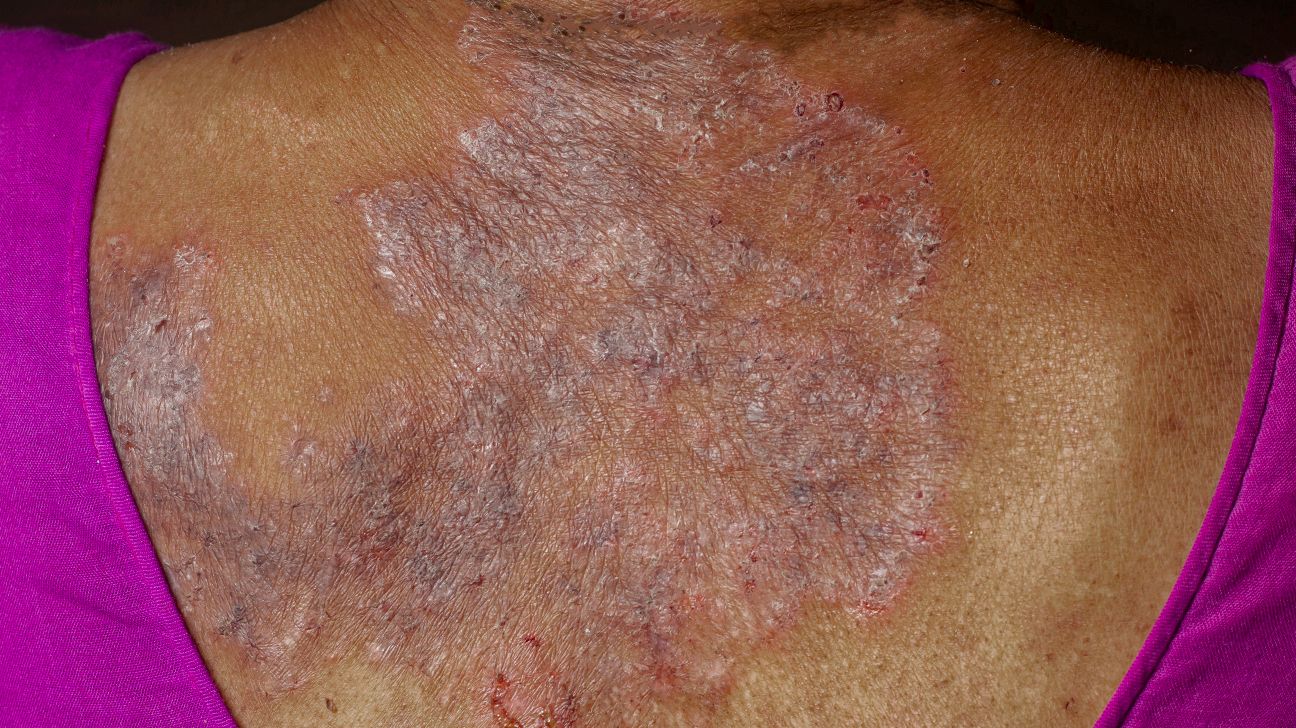 What Causes Brown Dry Spots On Skin - Infoupdate.org What Causes Brown Dry Spots On Skin - Infoupdate.org