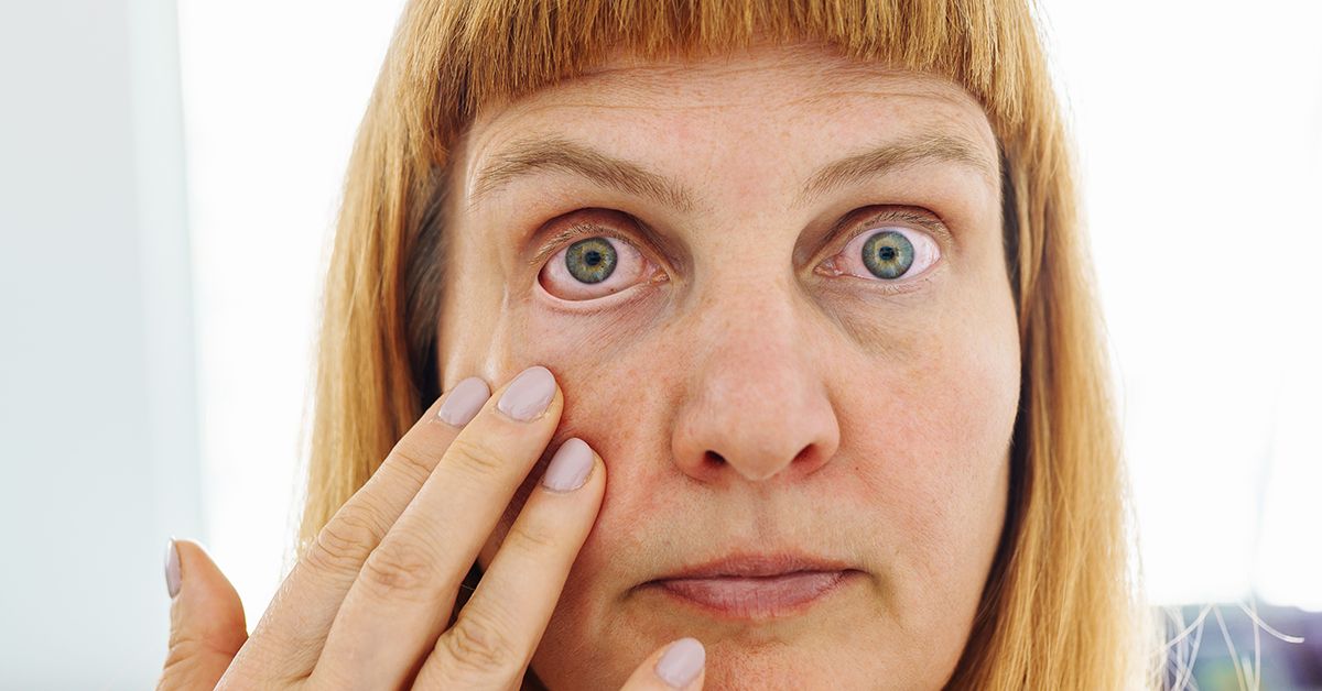 Blepharoconjunctivitis: Symptoms, Causes, Diagnosis, Treatment