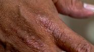 What Causes Brown Dry Spots On Skin Infoupdate What Causes Brown Dry Spots On Skin Infoupdate