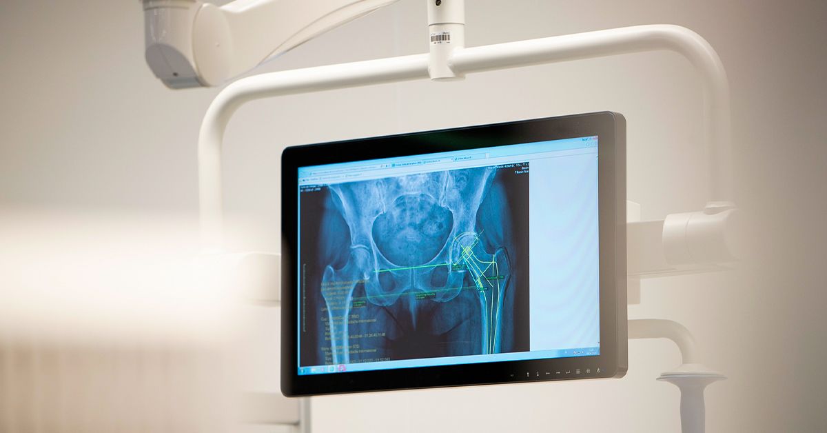 Avascular Necrosis in Sickle Cell Disease: Symptoms, Treatment