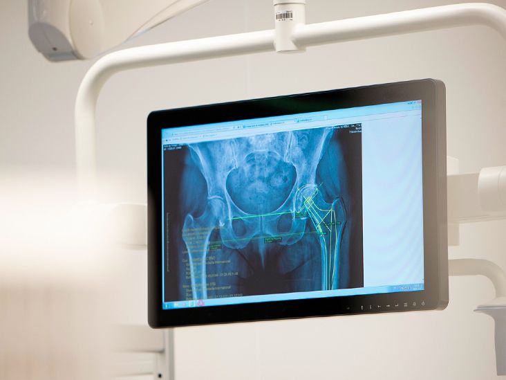 Avascular Necrosis in Sickle Cell Disease: Symptoms, Treatment