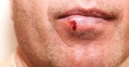 Lip Cancer Photos Early Session 2022 Infoupdate Lip Cancer Photos Early Session 2022 Infoupdate