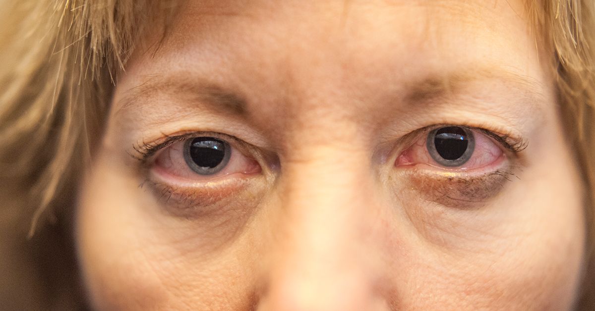 Bipolar Eyes: Are They Really a Thing?