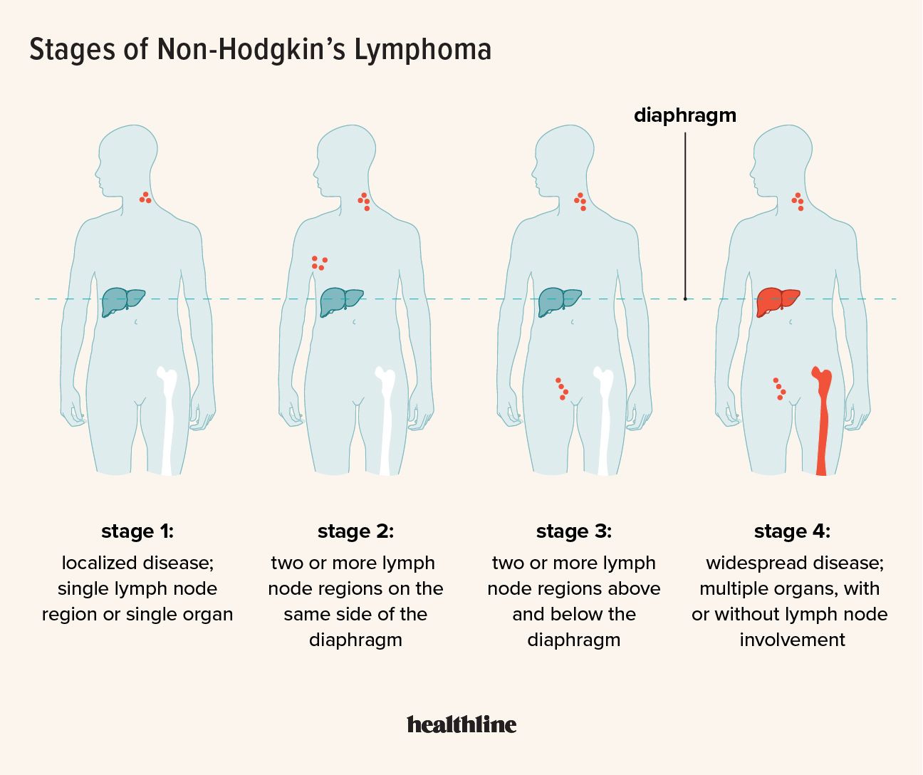 A Visual Guide to Non-Hodgkin’s Lymphoma