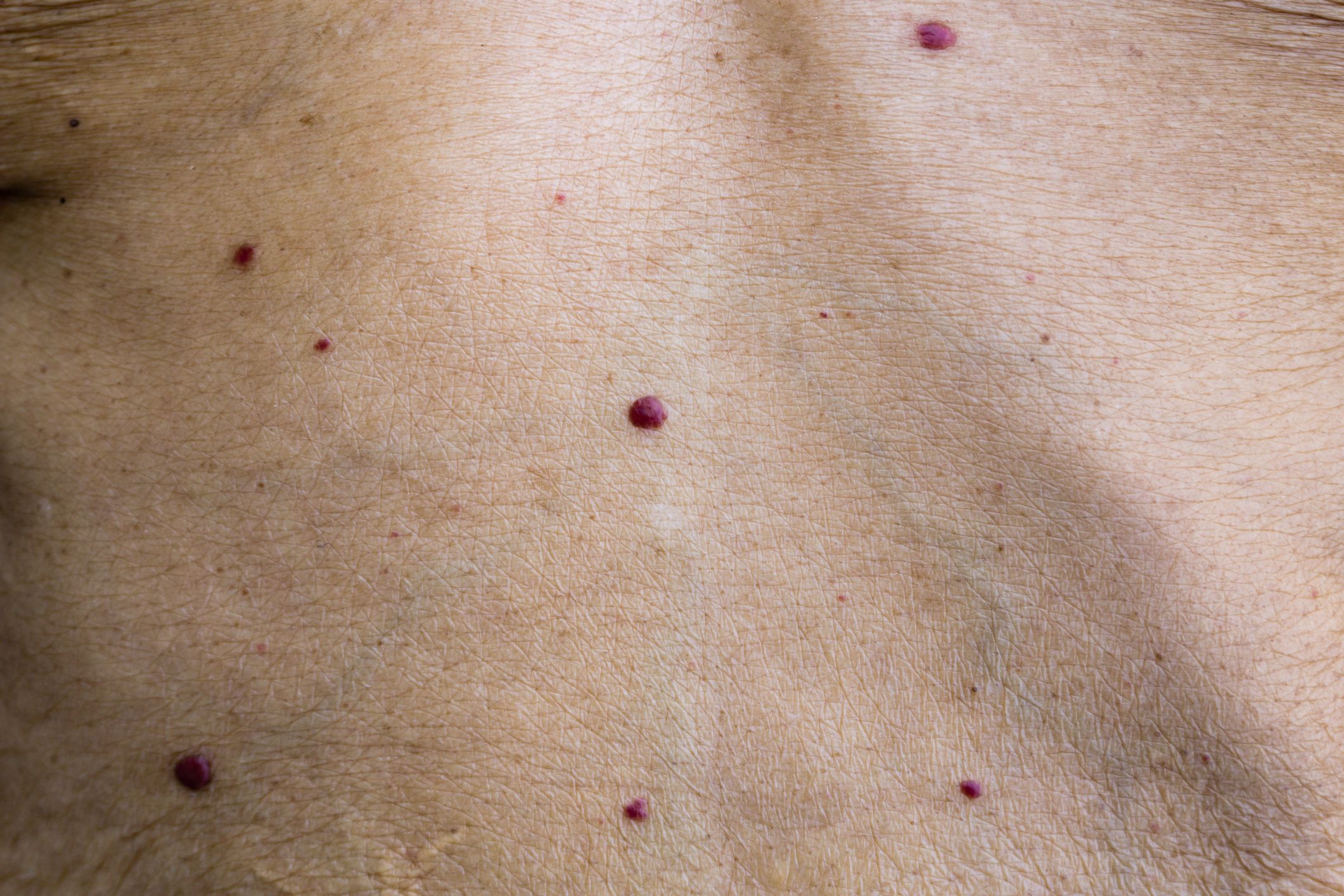 Capillary Angioma Vancouver Cherry Angioma Removal | Red Spots Removal