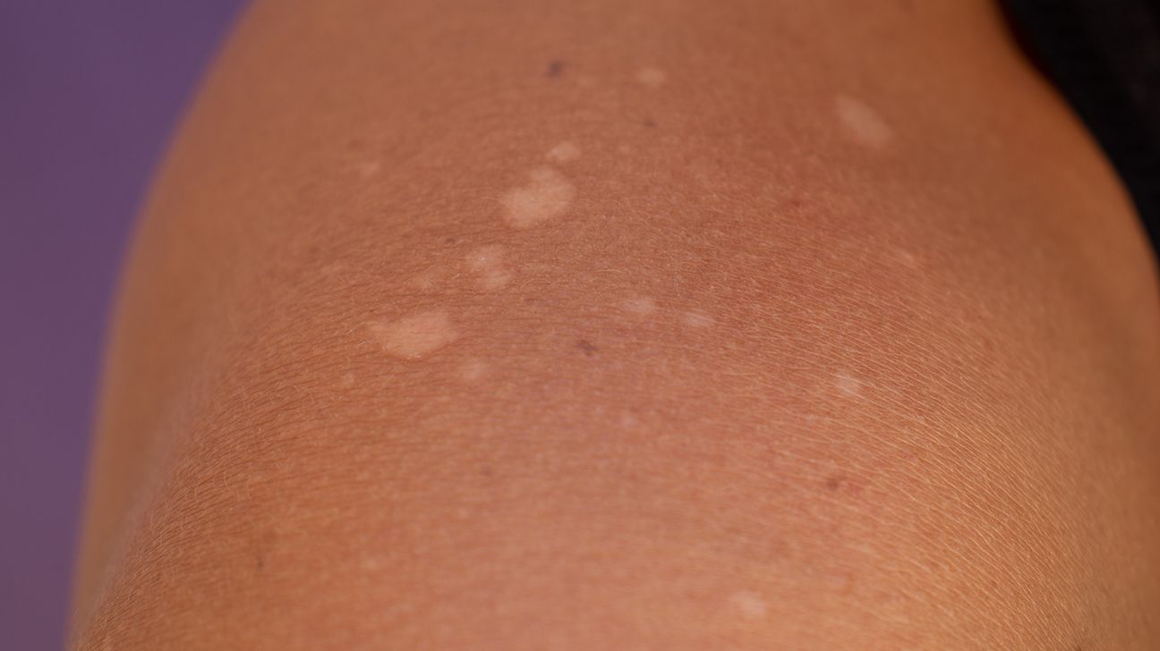 Should I Worry About White Spots On My Skin - Infoupdate.org