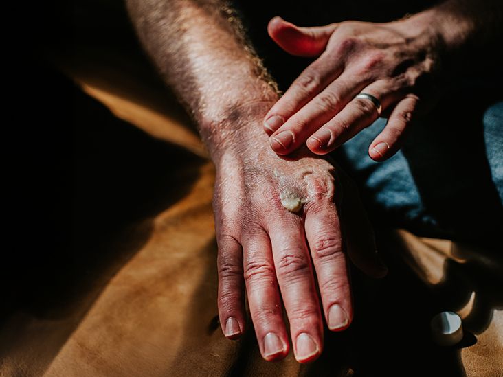 Dyshidrotic Eczema vs. Contact Dermatitis: Similarities and Difference