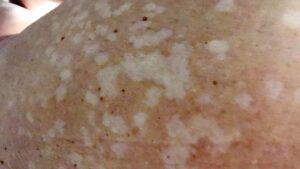 Can Sun Cause White Spots On Skin - Infoupdate.org