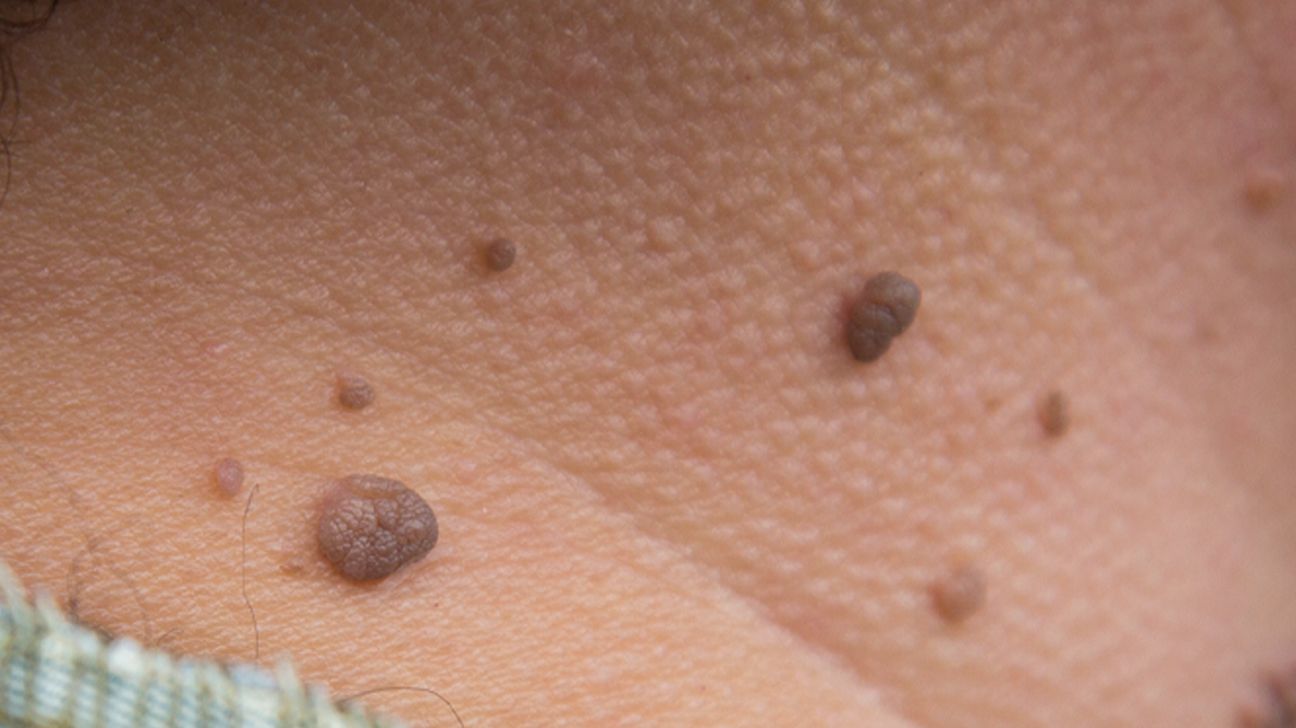 Nasal Wart Hpv