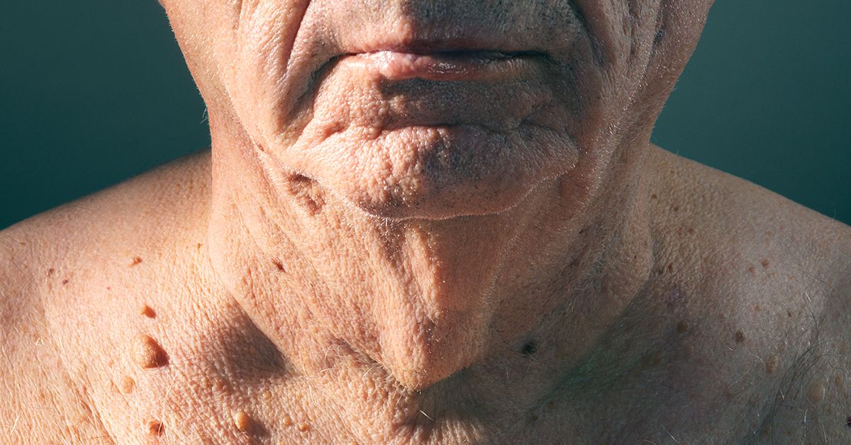 Does Medicare Cover Skin Tag Removal?