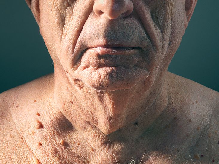 Does Medicare Cover Skin Tag Removal?