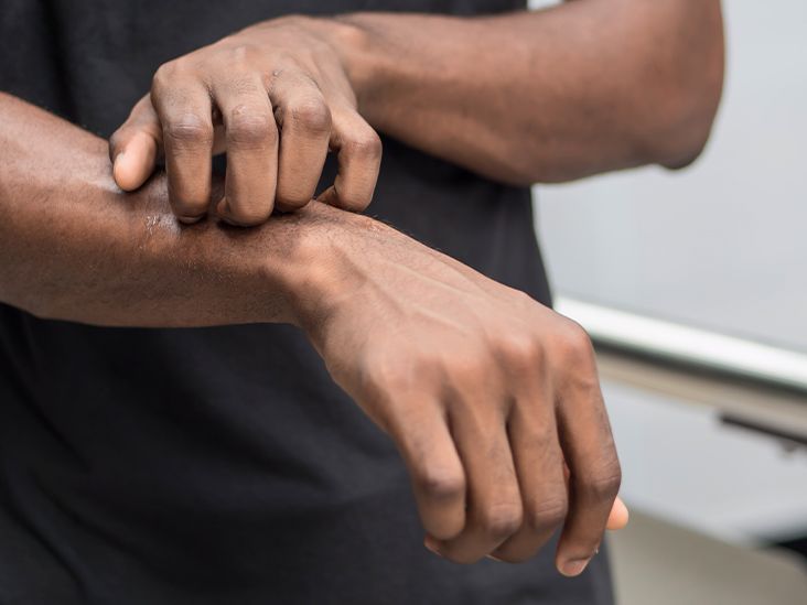 Pityriasis Rosea vs Ringworm: Photos, Symptoms, Causes, Treatment