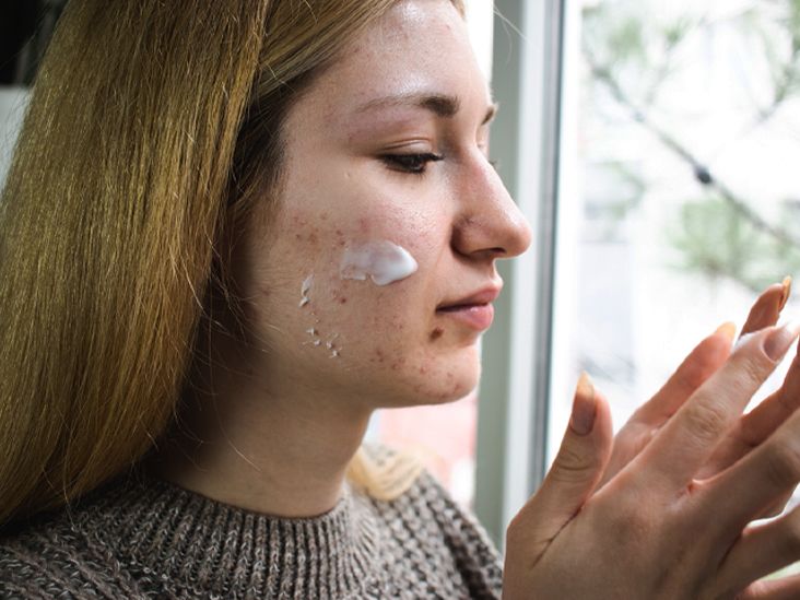 6 Things to Know About IUDs and Acne: Triggers, Treatment, and More