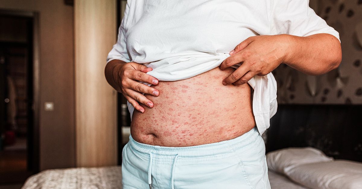 Is a Pityriasis Rosea Rash on Stomach Not Itchy?