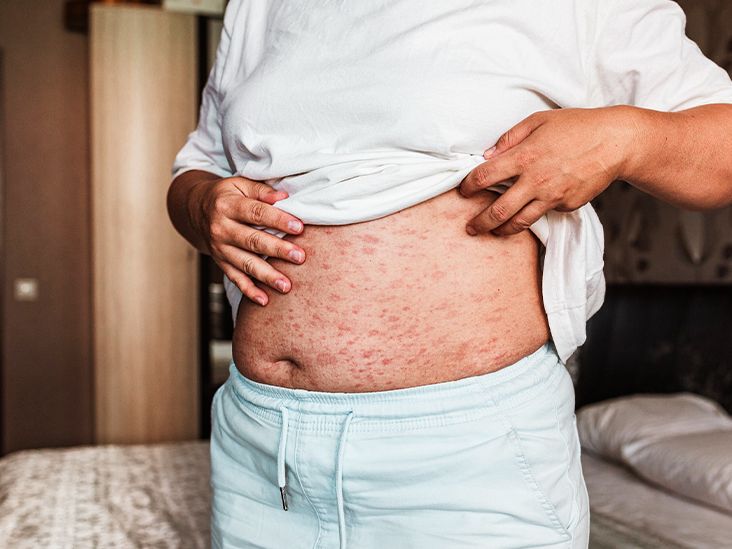 Heat Rash Stomach What's This Rash? : R/newborns