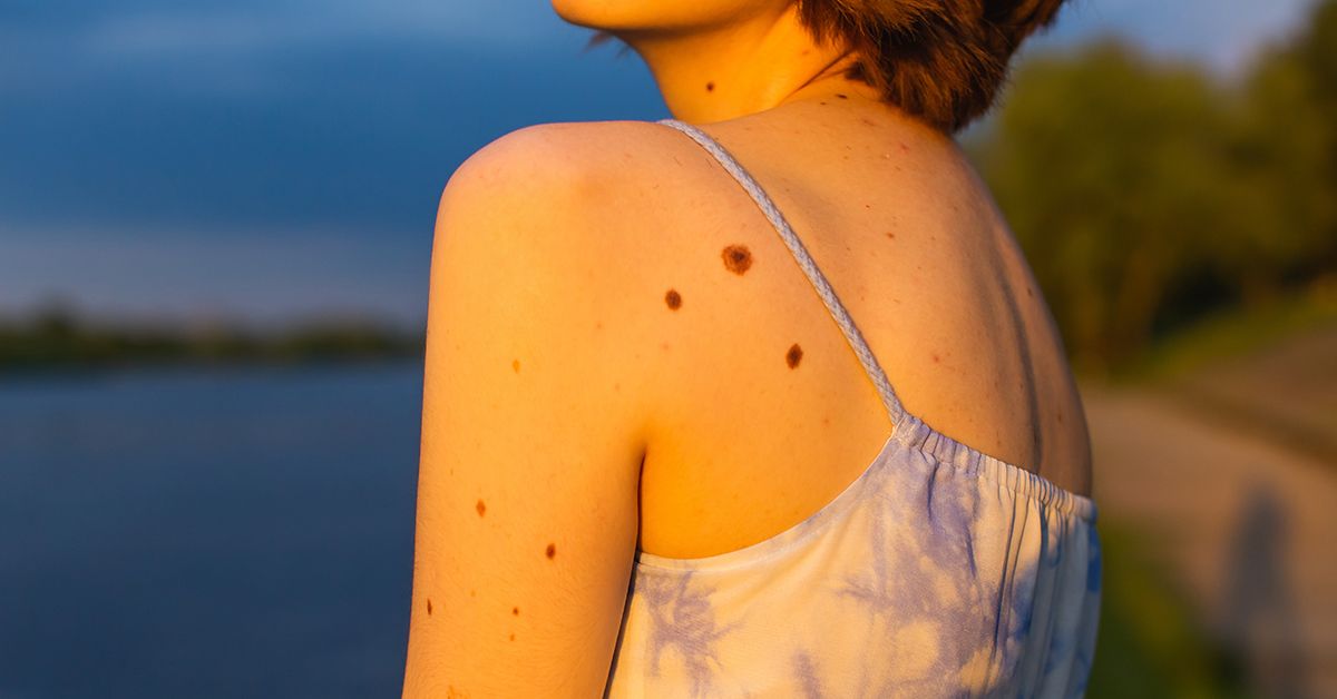 Freckles vs. Moles: Differences and Similarities