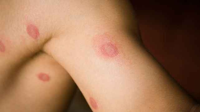 Skin Infection Pictures Types Causes and Treatments
