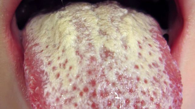 Bacterial Infection Face