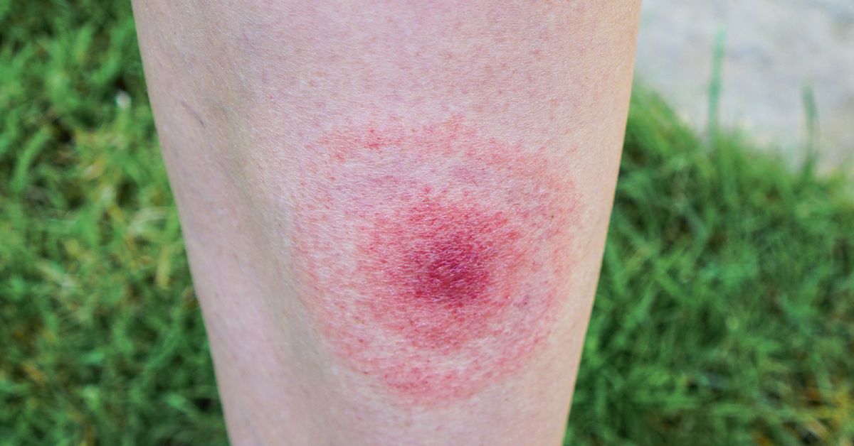 Erythema Migrans vs. Erythema Multiforme