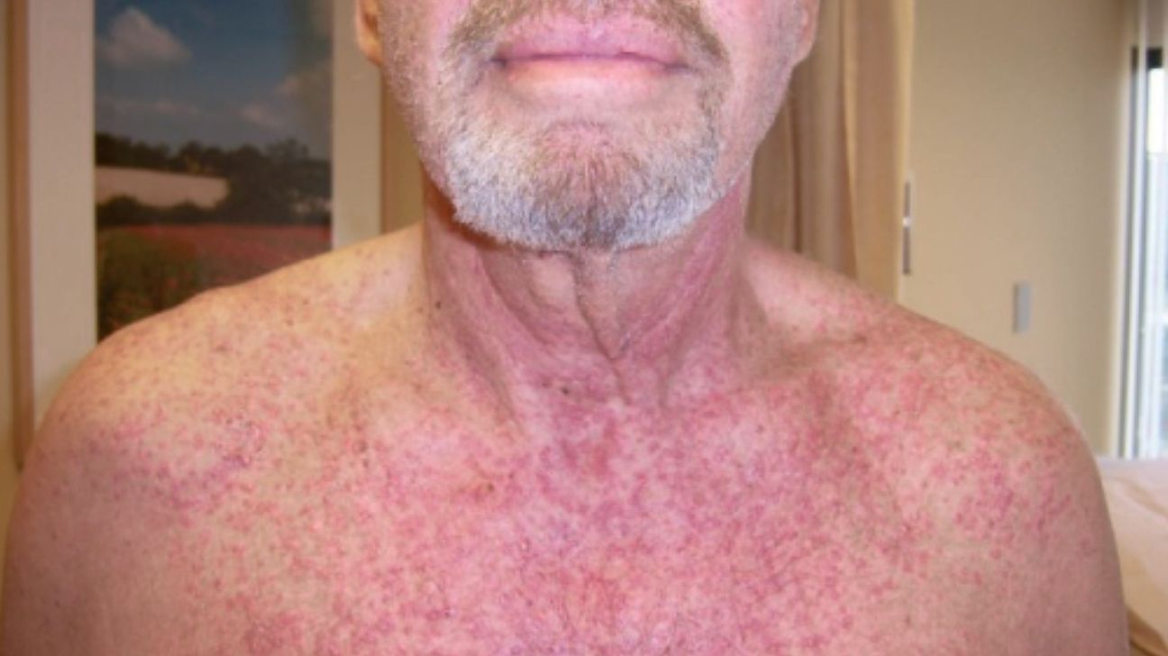Chemo Rash: Causes, Pictures, Treatment, and Prevention