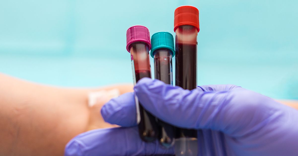 Factor VIII Assay: Purpose, Preparation, Results, and More