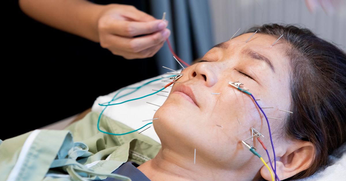 A Guide to Acupuncture for Menopause Symptoms