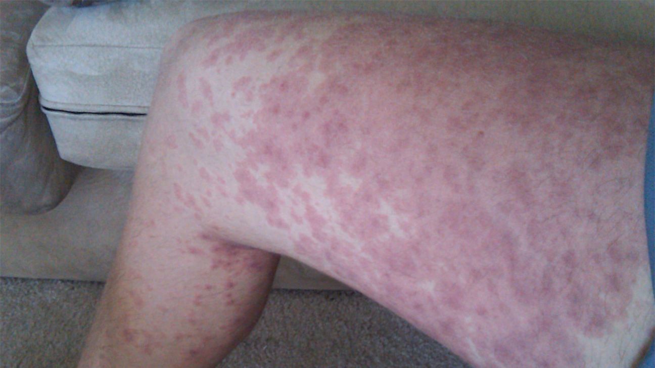 Chemo Rash: Causes, Pictures, Treatment, and Prevention