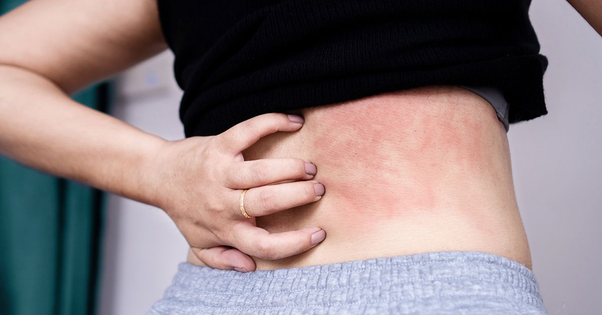 Hives During Your Period: Causes, Symptoms, and Treatment Options