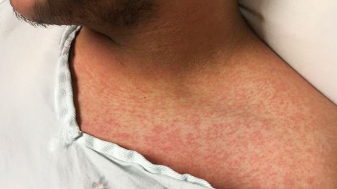 Chemo Rash: Causes, Pictures, Treatment, and Prevention