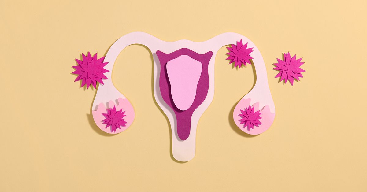 Why Do Most Ovarian Cancers Start in Fallopian Tubes?