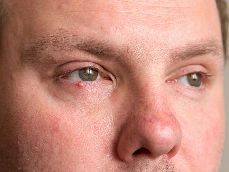 Chalazion vs. Hordeolum (Stye): Symptoms, Causes, Treatment