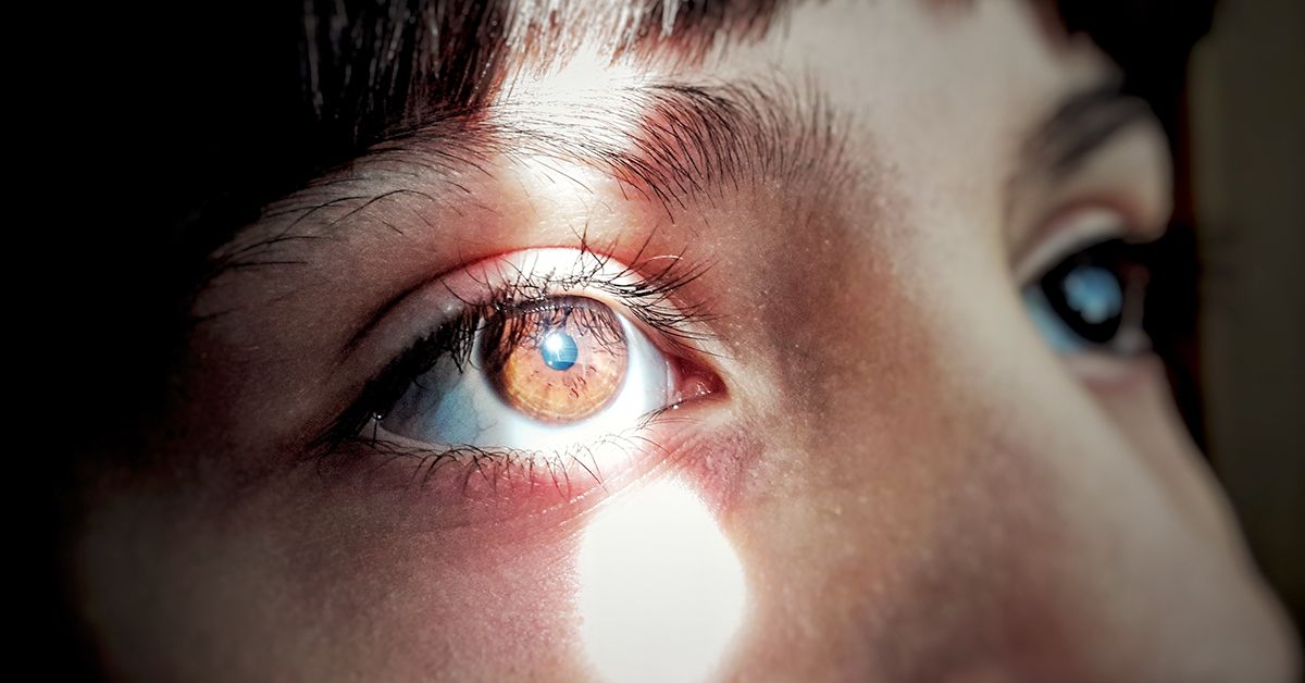 Myopic Macular Degeneration: Causes, Risk Factors, Treatment